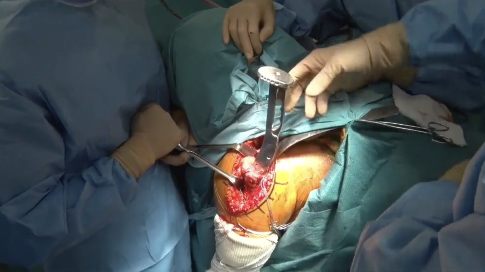 Latissimus Dorsi Transfer Combined with Bio-RSA - Nice Shoulder TV