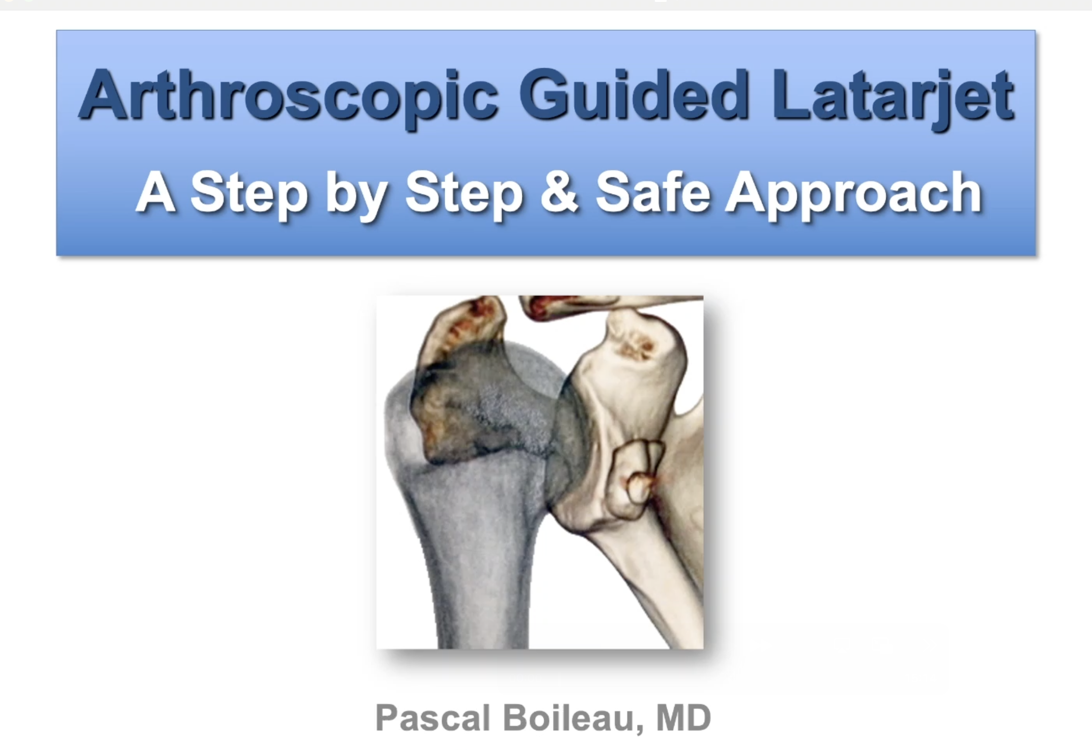 Arthroscopic Guided Latarjet: a step by step & safe approach - Nice ...